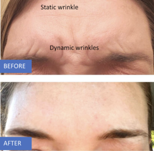 What is Preventative Botox? - Bloom - Advanced Med Spa