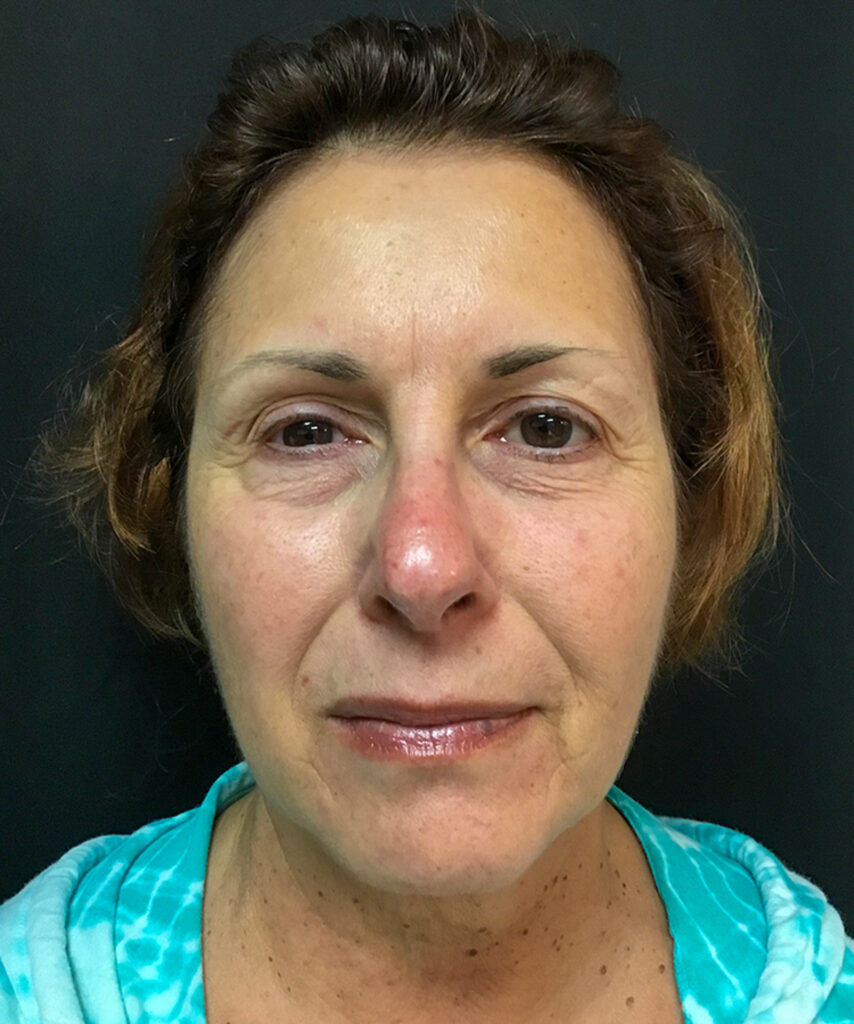 Bellafill - Bloom - Advanced Med Spa